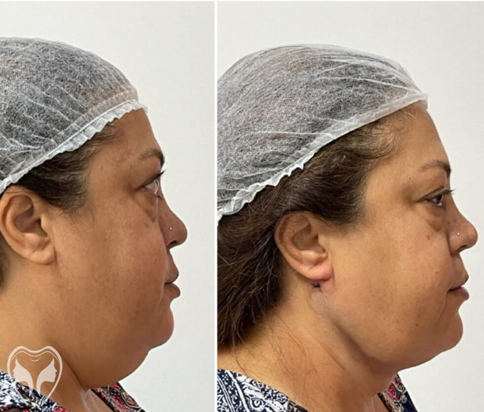 Lipo de Papada em Curitiba - Dra Daniele Guerra Daros