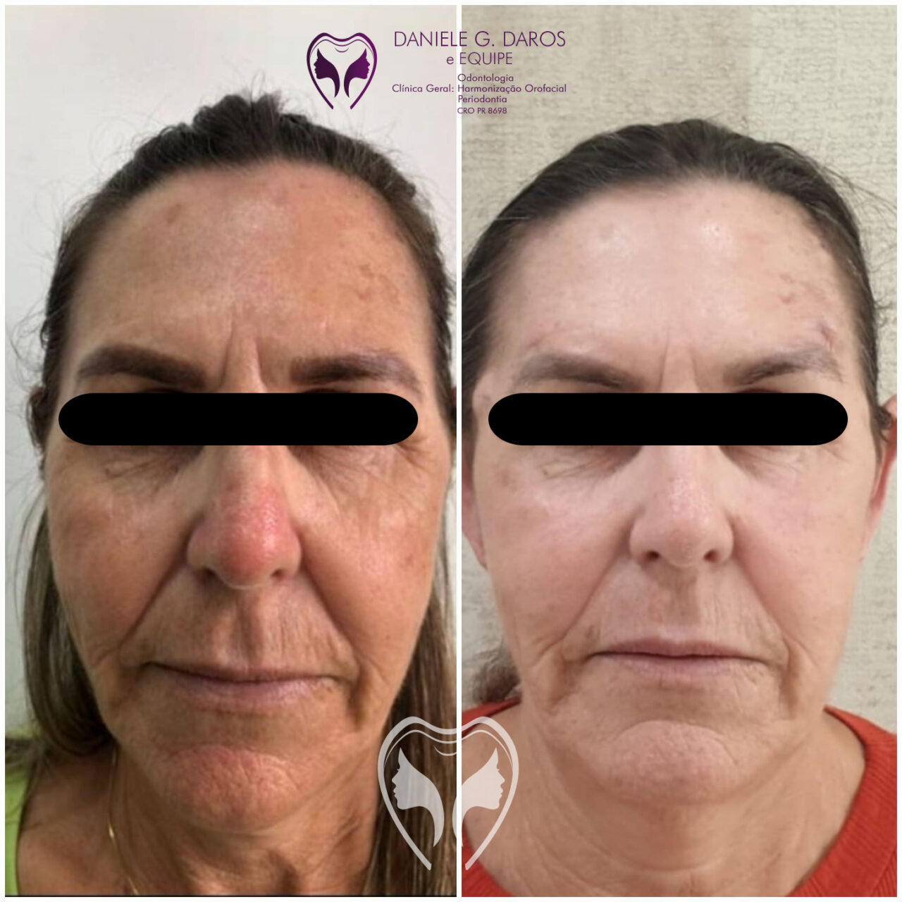 Lifting temporal não cirúrgico - Dra Daniele Guerra Daros